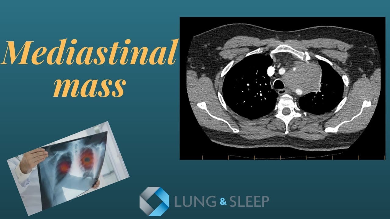 Mediastinal mass - what is the cause? Lymphoma, small cell carcinoma, sarcoid or tuberculosis ...
